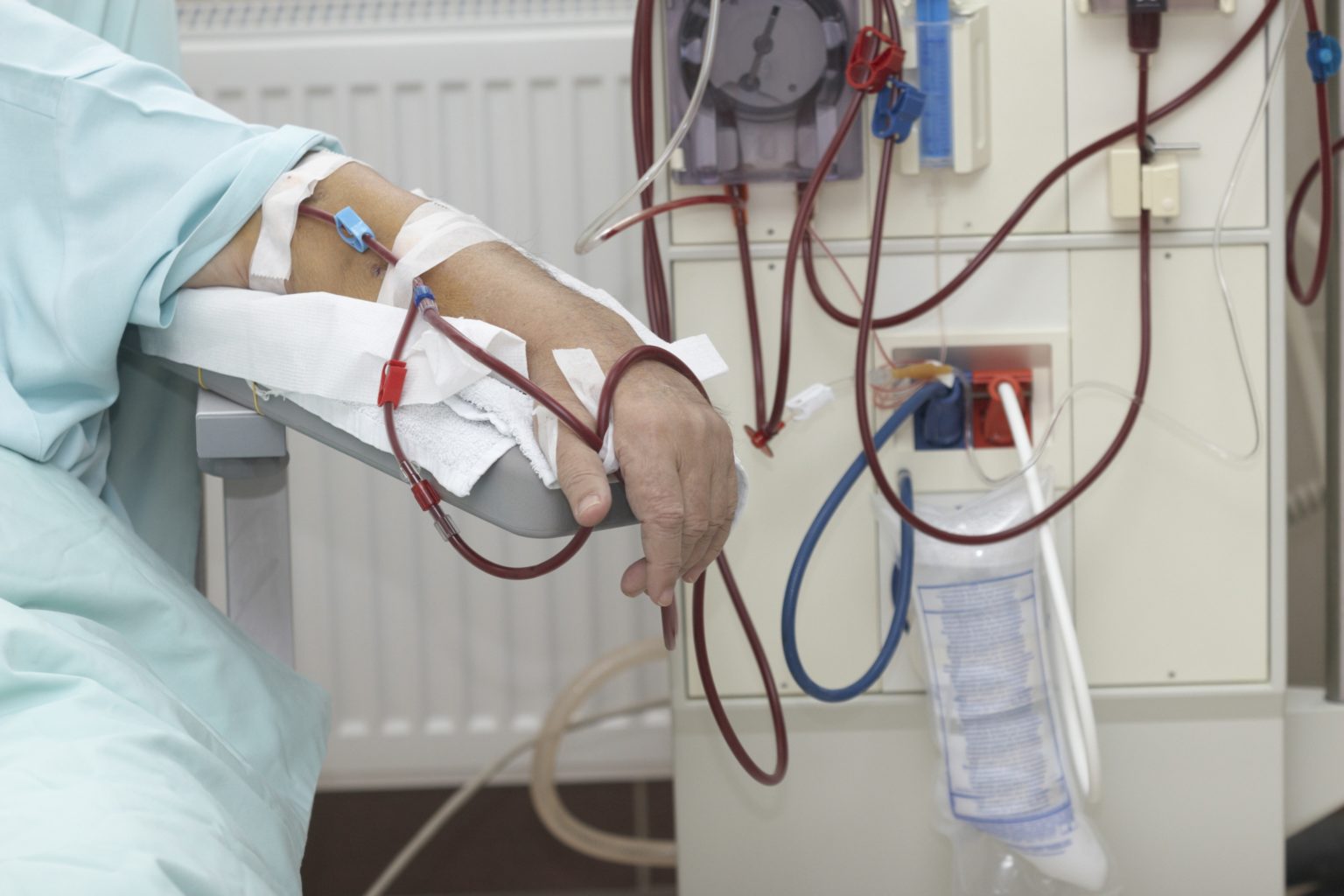 Inpatient Dialysis Show Low AZ - Hospital Dialysis Lakeside